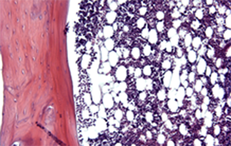 Fabrique de savoirs - Identification de cellules chimiorésistantes dans ...