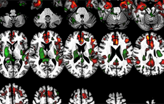 Frédéric Joliot Institute for Life Sciences - 7T Sodium MRI confirms ...