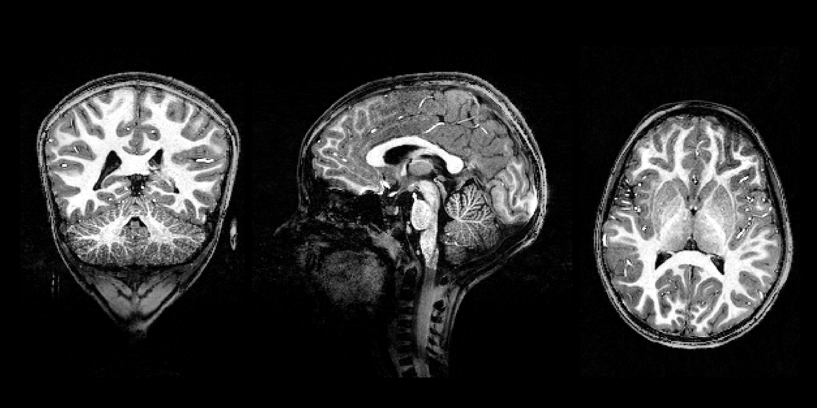 Recherche et innovation - L’imagerie cérébrale atteint une précision ...